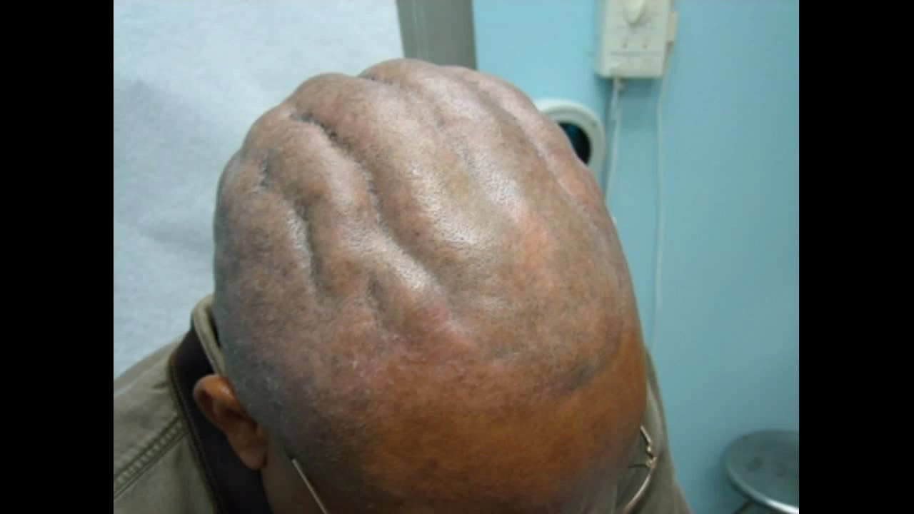 Diagnosis Of Cutis Verticis Gyrata ? - YouTube