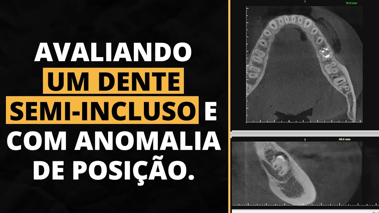 AVALIANDO UM DENTE SEMI-INCLUSO E COM ANOMALIA DE POSIÇÃO - YouTube