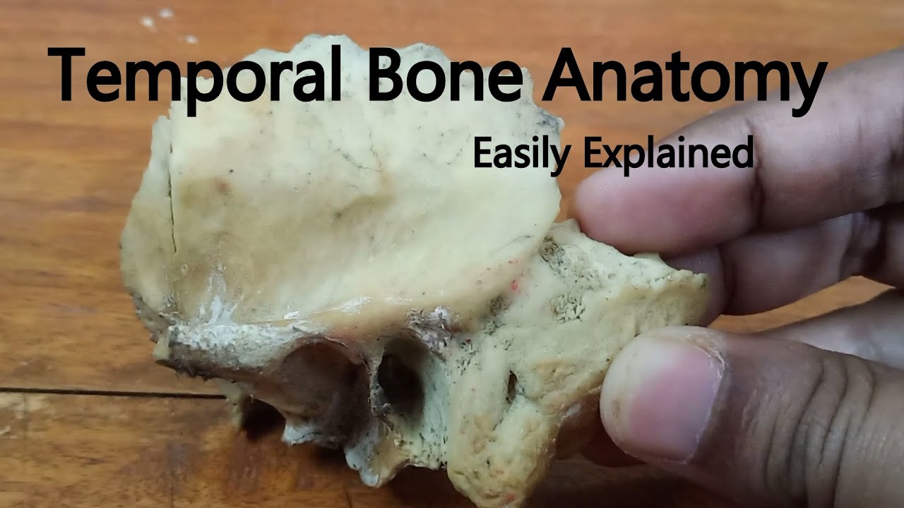 Surgical Anatomy of Temporal Bone: Points to Know Before Mastoid ...
