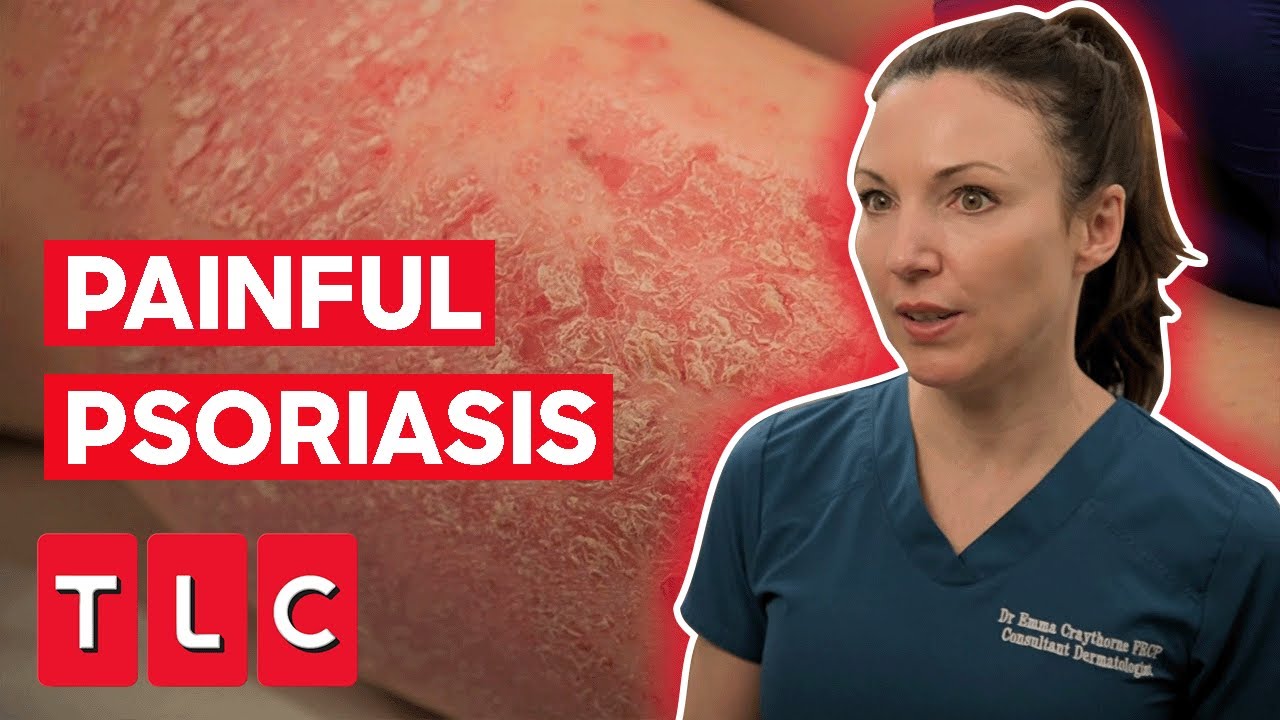 Dr. Emma Helps 21-Year-Old Woman With Her Psoriasis | The Bad Skin ...