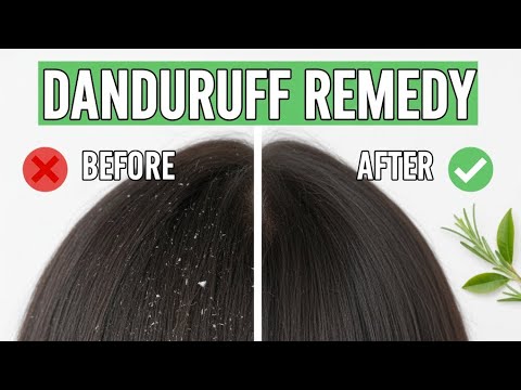 Quick Fix for Dandruff | 2-Ingredient Natural Remedy - YouTube