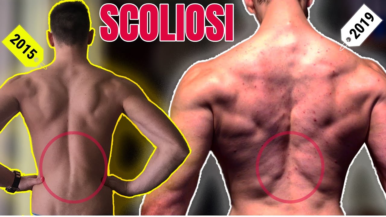 SCOLIOSI, ERNIA e DOLORE LOMBARE - Come HO RISOLTO Dopo TANTI TENTATIVI ...