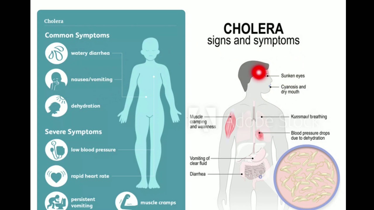 Cholera Symptoms And Signs