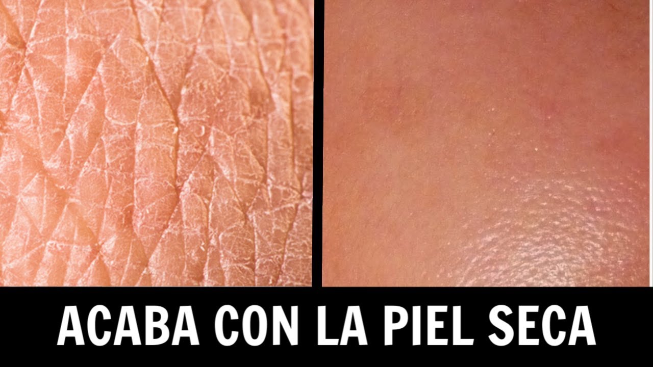 Cómo acabé con la piel seca | Ana Mireles - YouTube