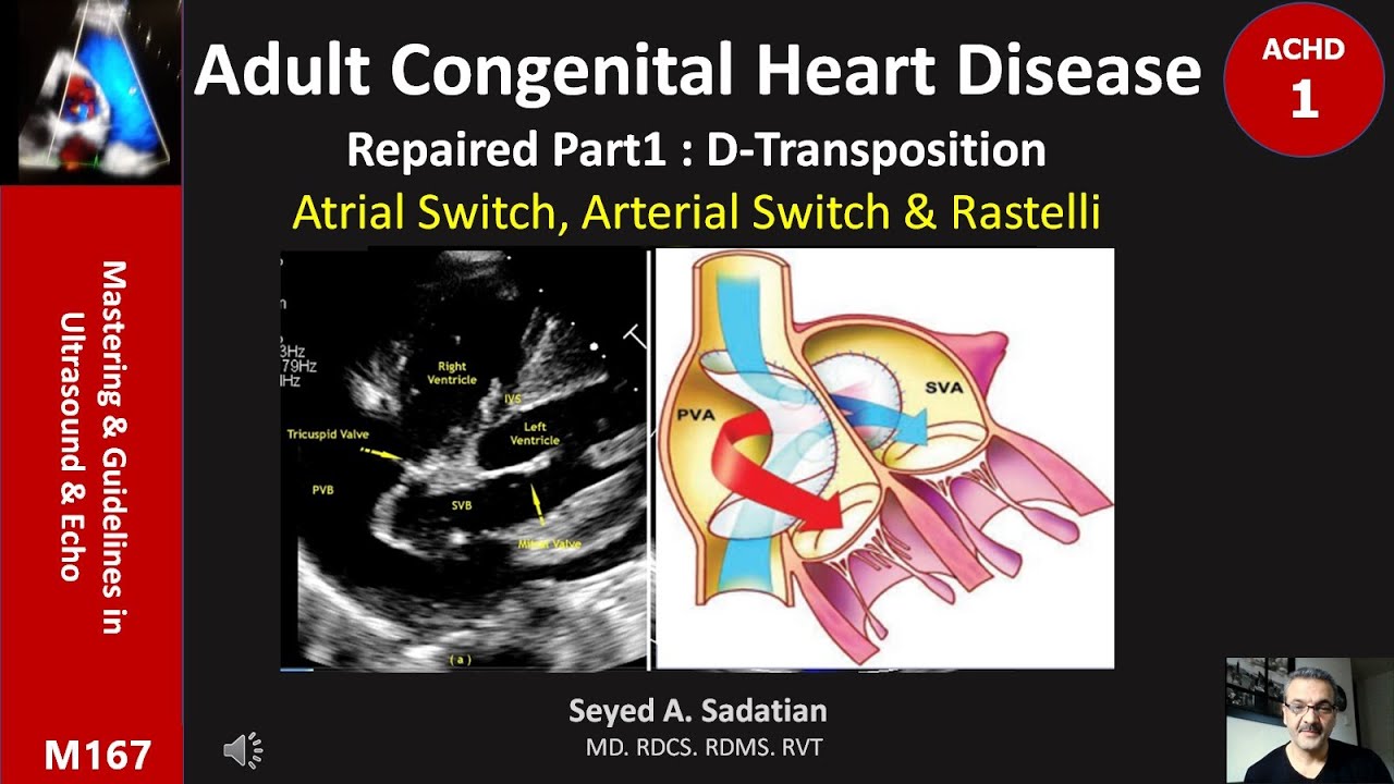 ACHD1: Repaired D - transposition; Atrial Switch, Arterial Switch ...