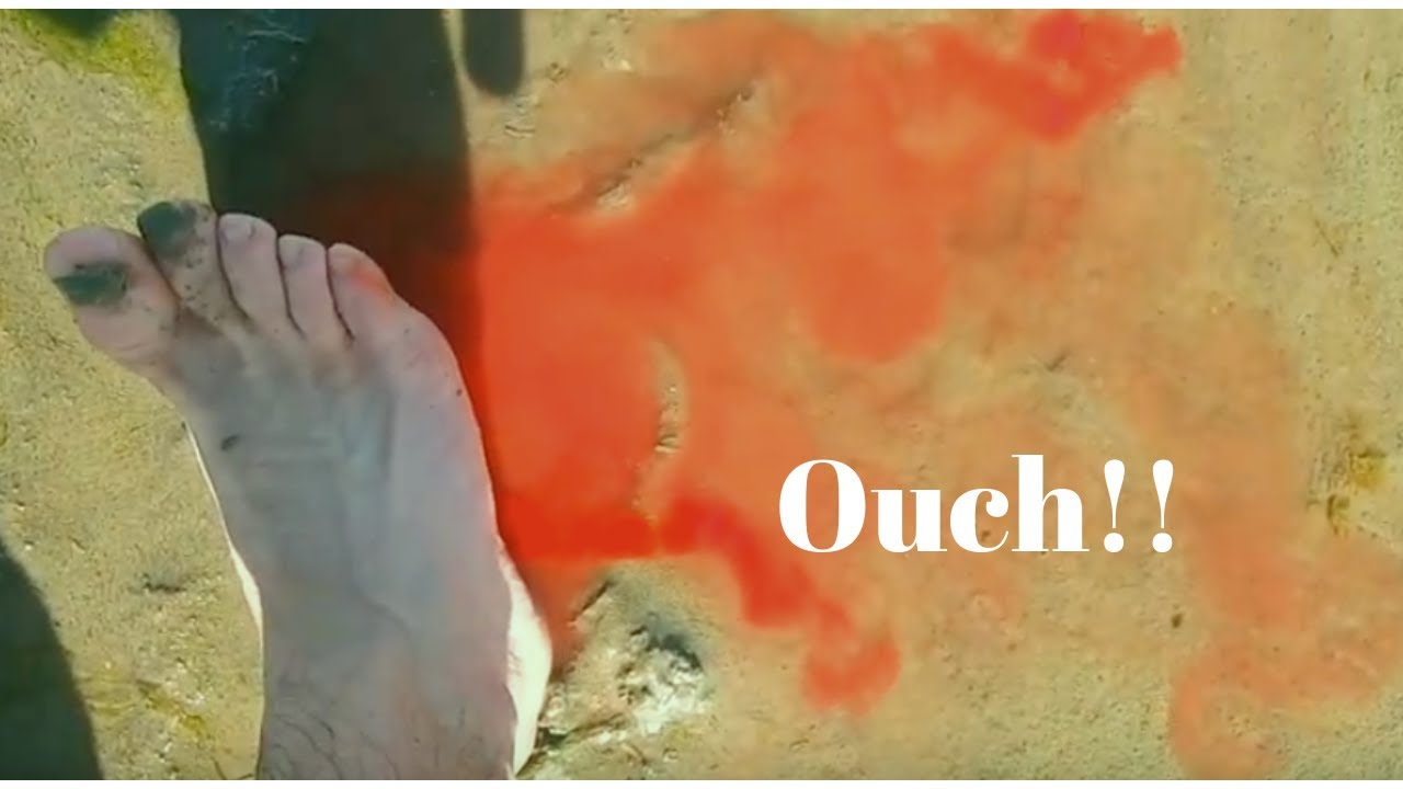 Horrible beach injury (lots of blood!!) - YouTube