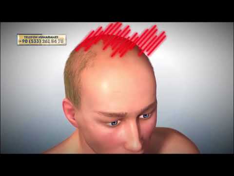 HairInn - Lazer Duşu Tedavi Tanıtımı