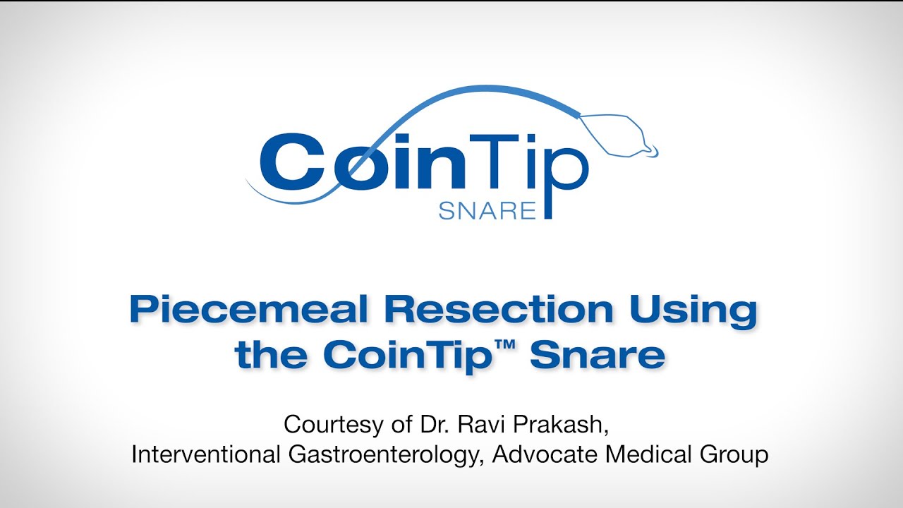 Piecemeal Resection Using the COINTIP™ Snare - YouTube