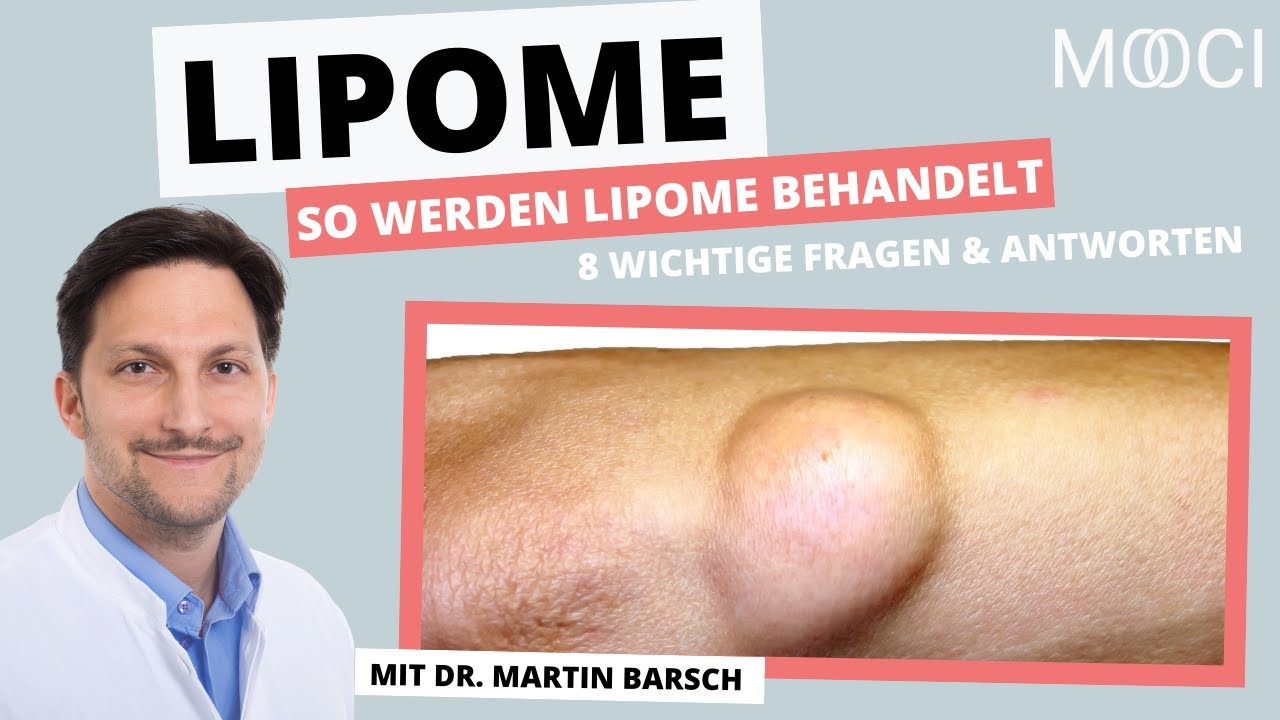 Wie kann ich Lipom behandeln? 8 wichtige Infos - YouTube