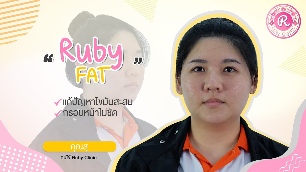 ฉีดสลายไขมันแก้ม เหนียง เพื่อกรอบหน้าที่ชัดมากขึ้น ดูมีแก้มน้อยลงคร้า ...