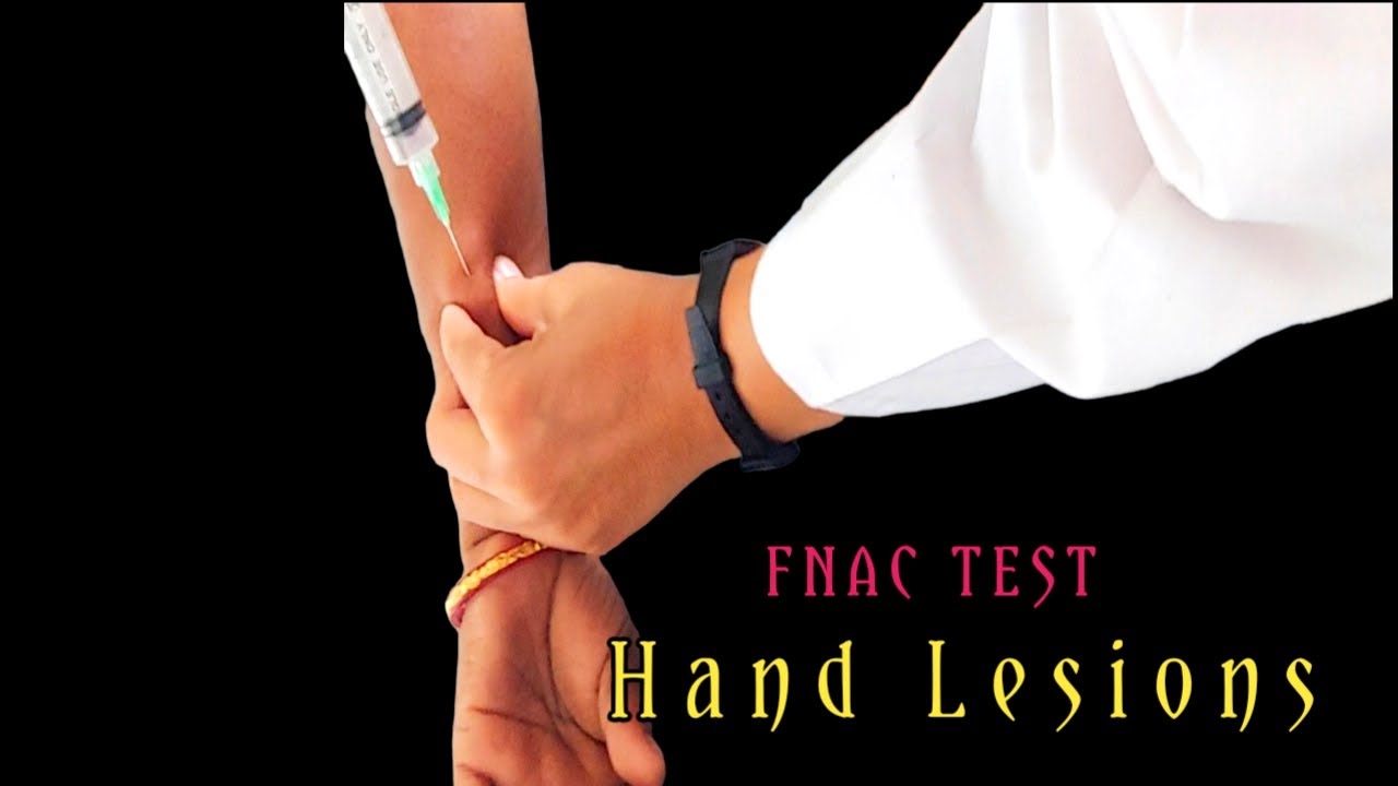 FNAC Test For Hand Lesions।। - YouTube