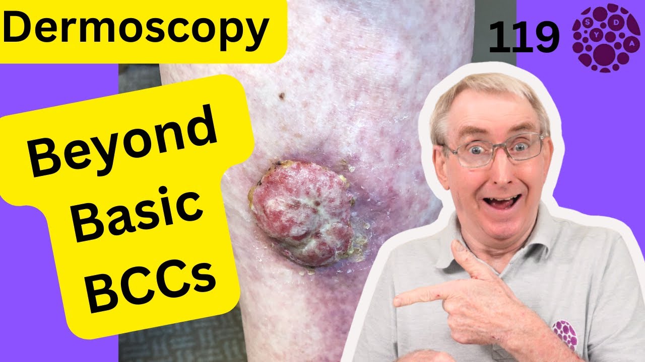 Uncover the secrets of Big Basal Cell Cancers, as I take you beyond the ...