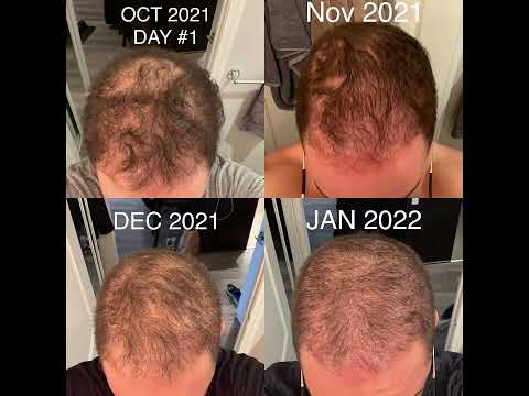 Finasteride 1 MG - 1 year Complete Results - Minoxidil 5% Kirkland ...