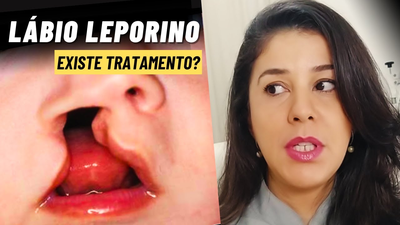 Lábio leporino e fenda palatina: o que é, quais as causas e tratamento ...