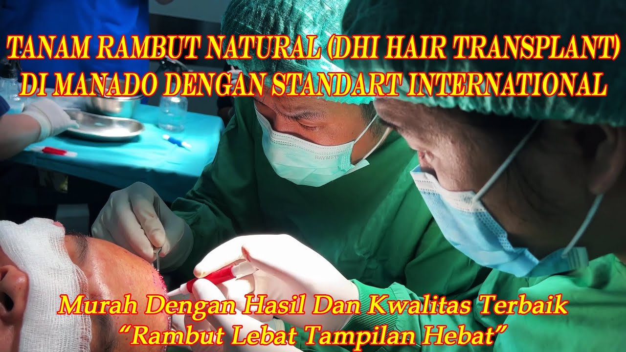 TANAM RAMBUT DI MANADO HAIR TRANSPLANT - YouTube
