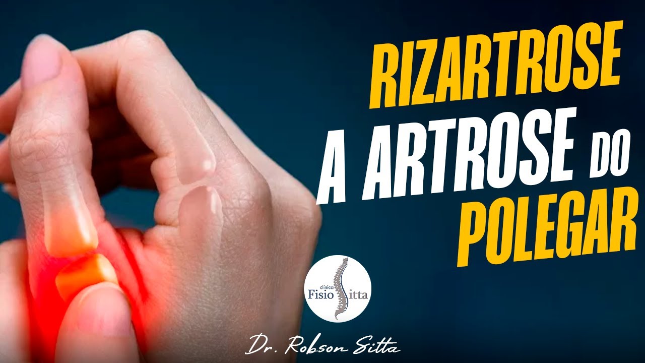 RIZARTROSE ARTROSE do POLEGAR PROTOCOLO de TRATAMENTO em CASA Clínica ...