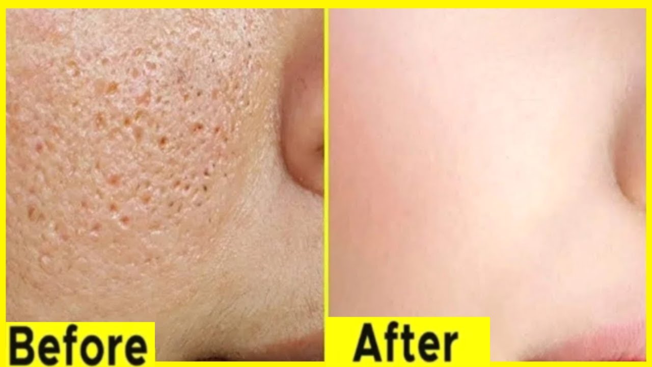 Skin Repair | Close Large OPEN PORES in 1 week, Remove Dark Spots, Anti ...