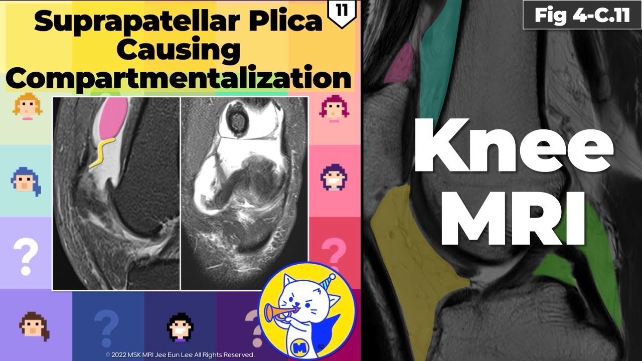 (Fig 4-C.11) Suprapatellar Plica Causing Compartmentalization - YouTube