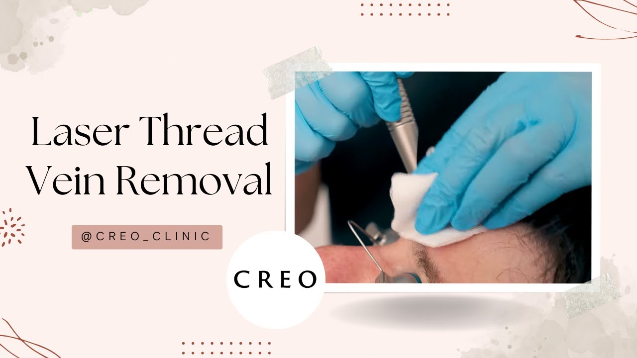 Laser Thread Vein Removal - YouTube