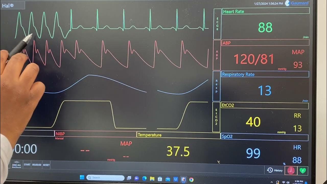 Analyzing Ventricular ECG Rhythms: PVC, VT runs, Ventricular ...