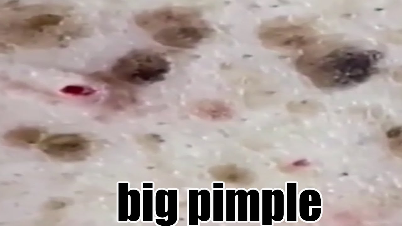 Big blackheads removal satisfying, top popping pimples asmr,acne ...