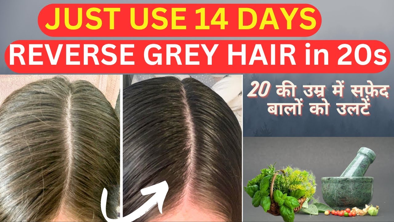 Cure Grey Hair Problem in Your 20s Naturally | Stop Premature Greying ...