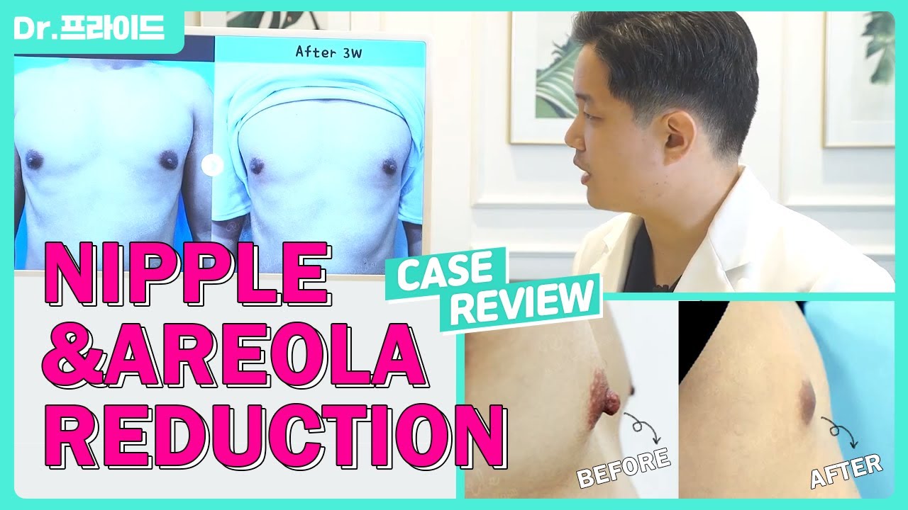 Nippleandareola Reduction For Man Youtube