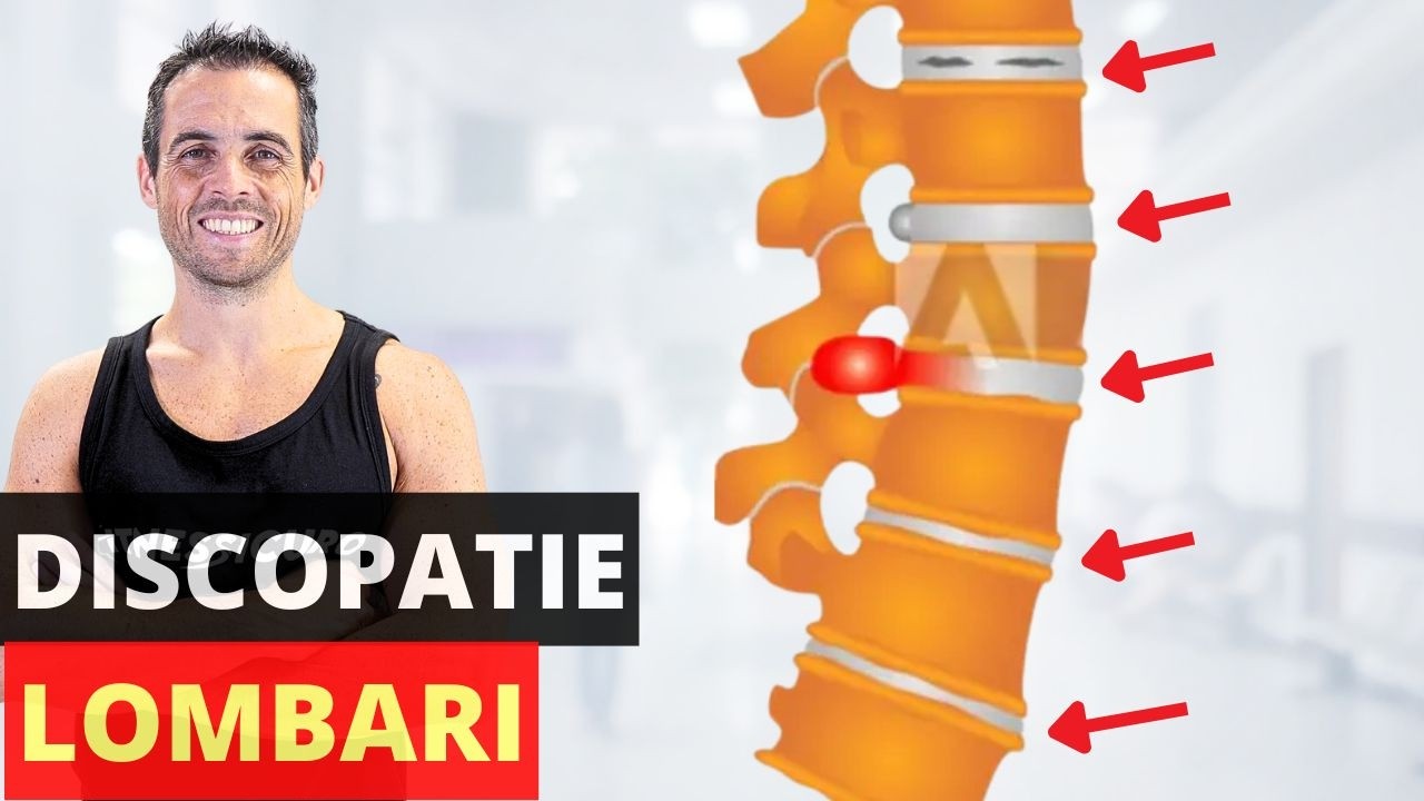 DISCOPATIE LOMBARI: gli esercizi più efficaci per risolvere il mal di ...