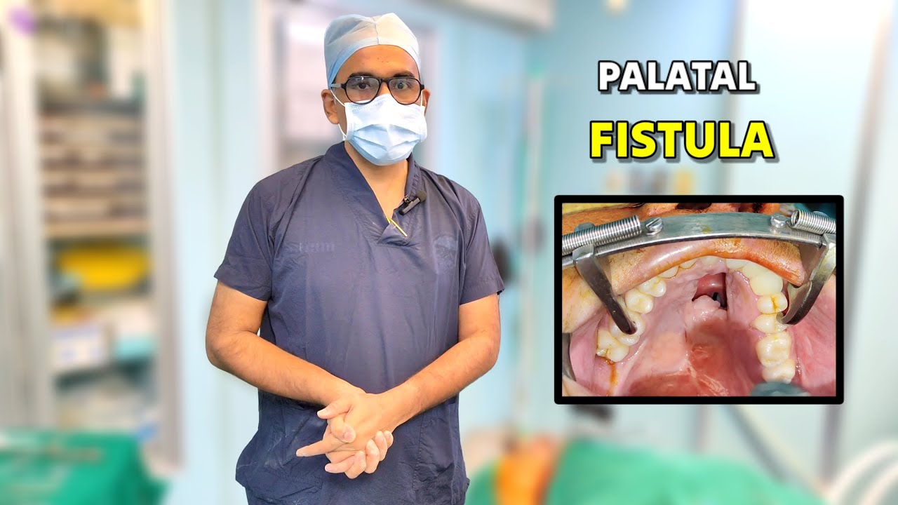 Big Palatal Fistula Closure using Tounge Flap by Dr Parit Ladani - YouTube