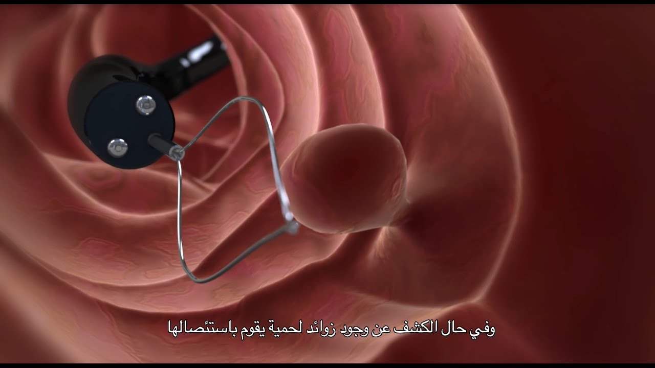 Colonoscopy Procedure: What Is a Colonoscopy Screening and How Its Done ...