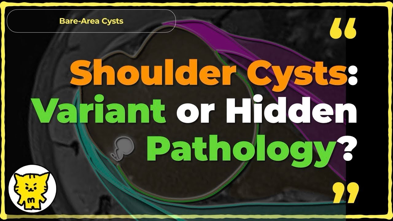 Shoulder Cysts on MRI: Normal Variant or Hidden Pathology? Bare area ...