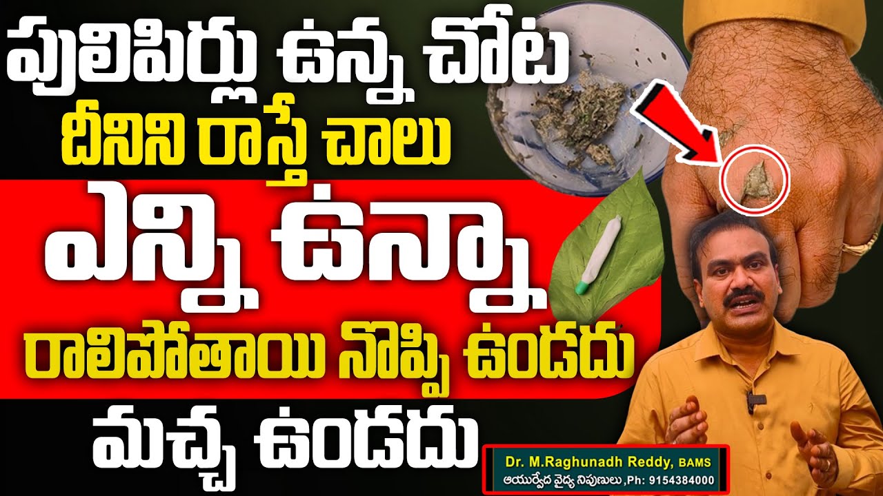 నొప్పి లేకుండా పులిపిర్లు మాయం | A Solution to Remove Warts | Warts on ...