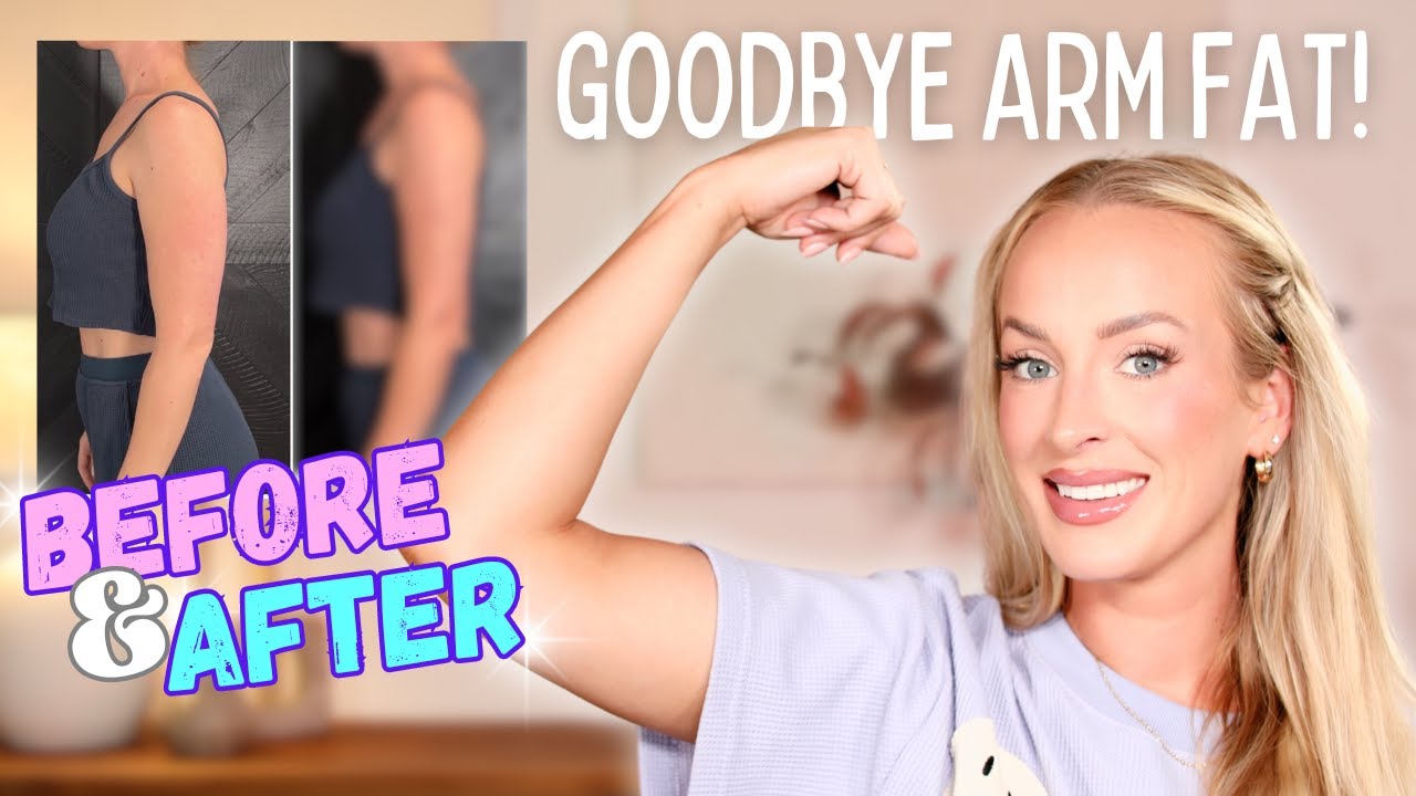 Everything About My Arm Liposuction Journey: Surgery, Recovery, and ...