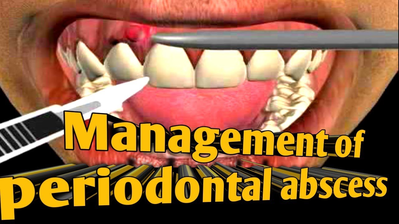 Management of periodontal abscess | Treatment of periodontal abscess ...