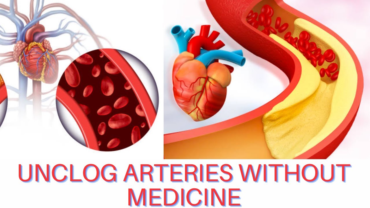 Unclog Arteries Without Medicine - YouTube
