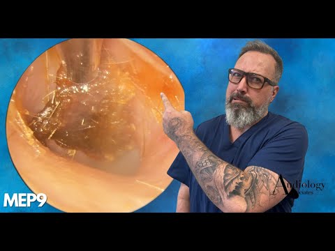 EAR WAX PEEL & CRUMBLY EAR WAX REMOVAL - MEP9 - YouTube