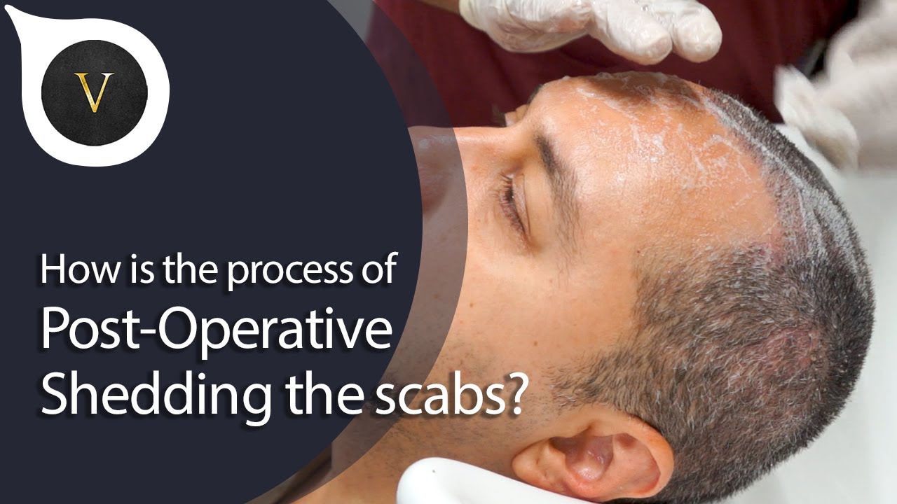 How is the process of post-operative shedding the scabs? - YouTube
