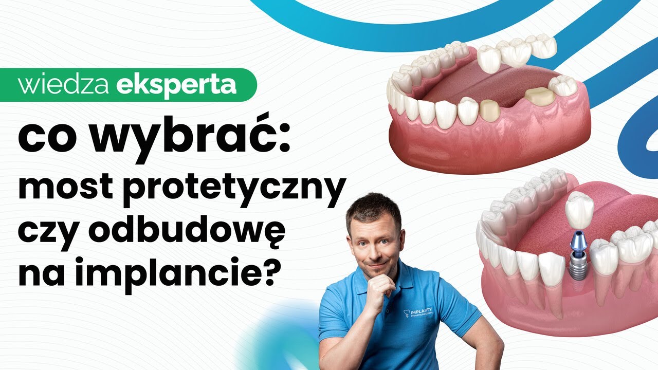 MOST NA IMPLANTACH A MOST NA ZĘBACH NATURALNYCH - KLUCZOWE RÓŻNICE ...