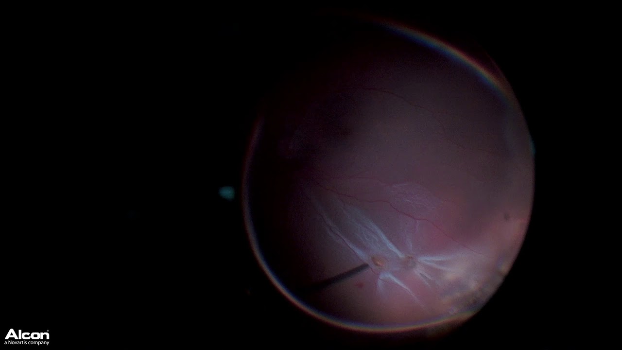 Utilizing a Large Radial Scleral Buckle to Repair a Retinal Detachment ...