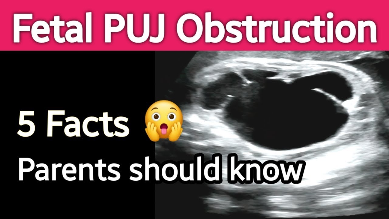 Fetal Dilated Renal Pelvis - PUJ obstruction | Ultrasound - 5 ...