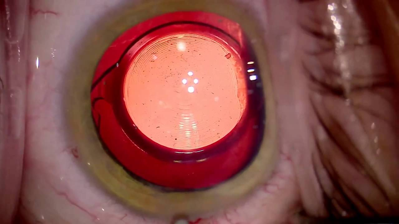 Proveo 8 Cataract - YouTube