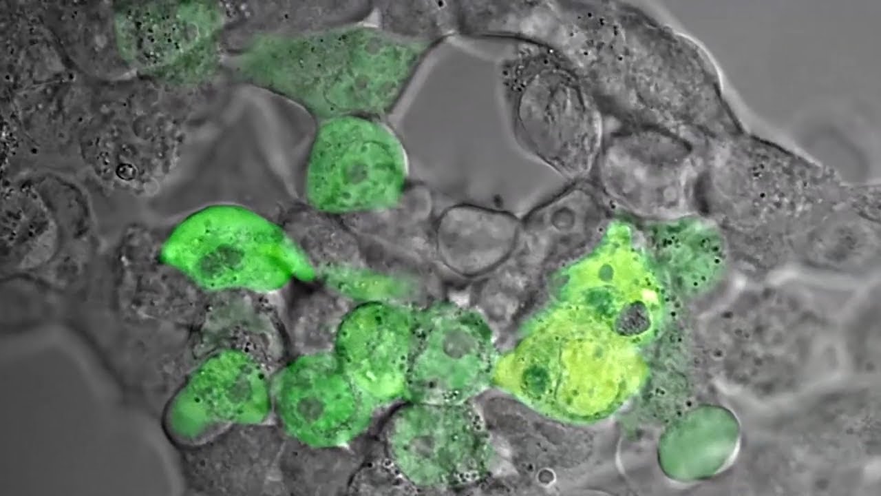 Glowing Tumor Surgery at Penn Medicine - YouTube