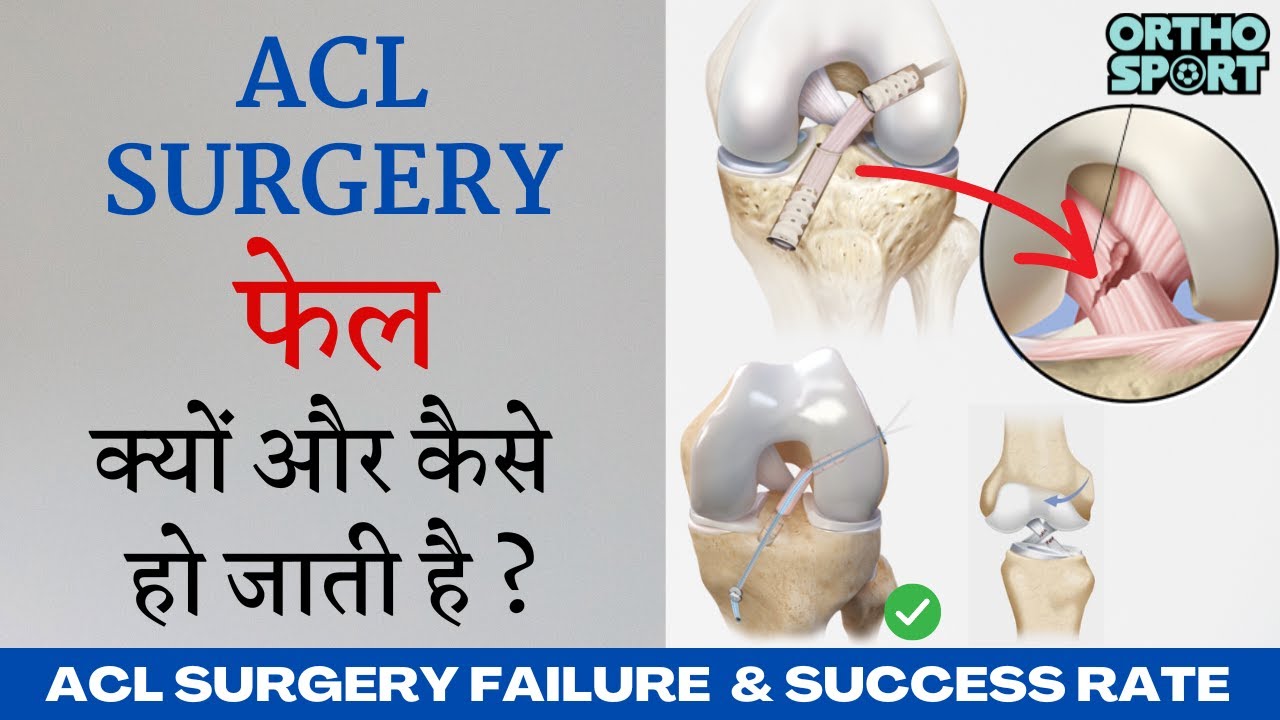 ACL Surgery फेल क्यों और कैसे हो जाती है ? #ACL Surgery Failure & # ...