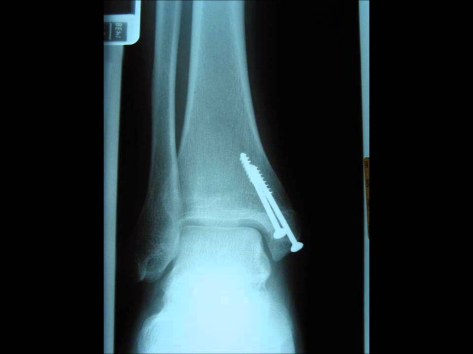 School Simple Machines Project: The Screw - YouTube