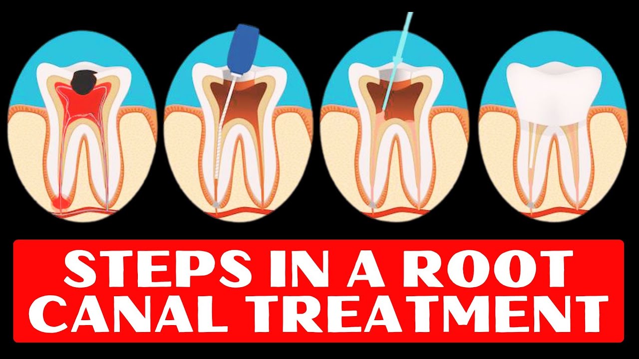 Different Stages of Root Canal Treatment - YouTube