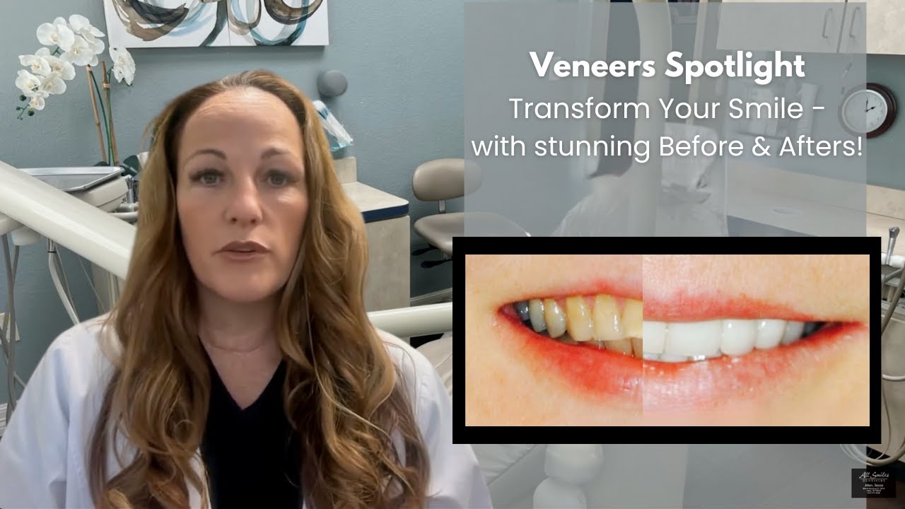 Veneers: Teeth Treatment for a Perfect Smile! - YouTube