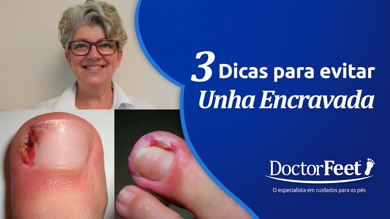 3 DICAS IMPERDÍVEIS PARA EVITAR A UNHA ENCRAVADA - YouTube