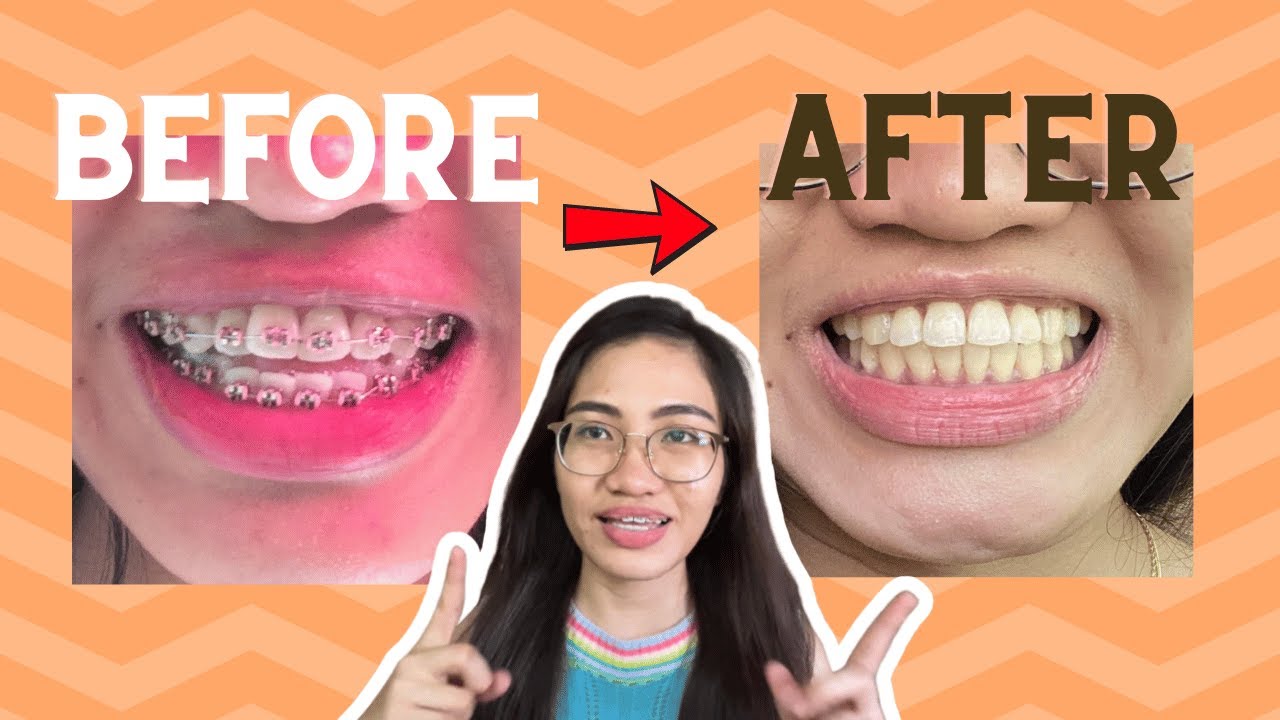 The story of my first braces journey - YouTube