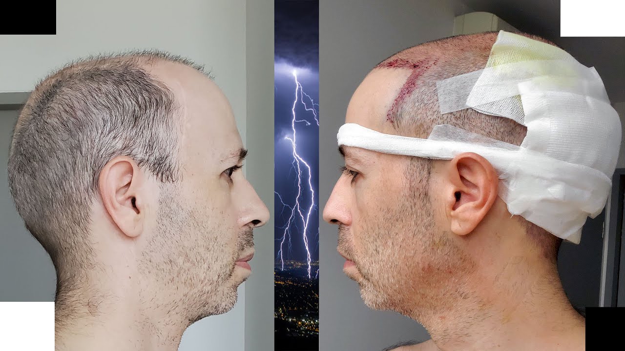 A Hair Raising Tale Part 7: Temple point hair restoration - YouTube