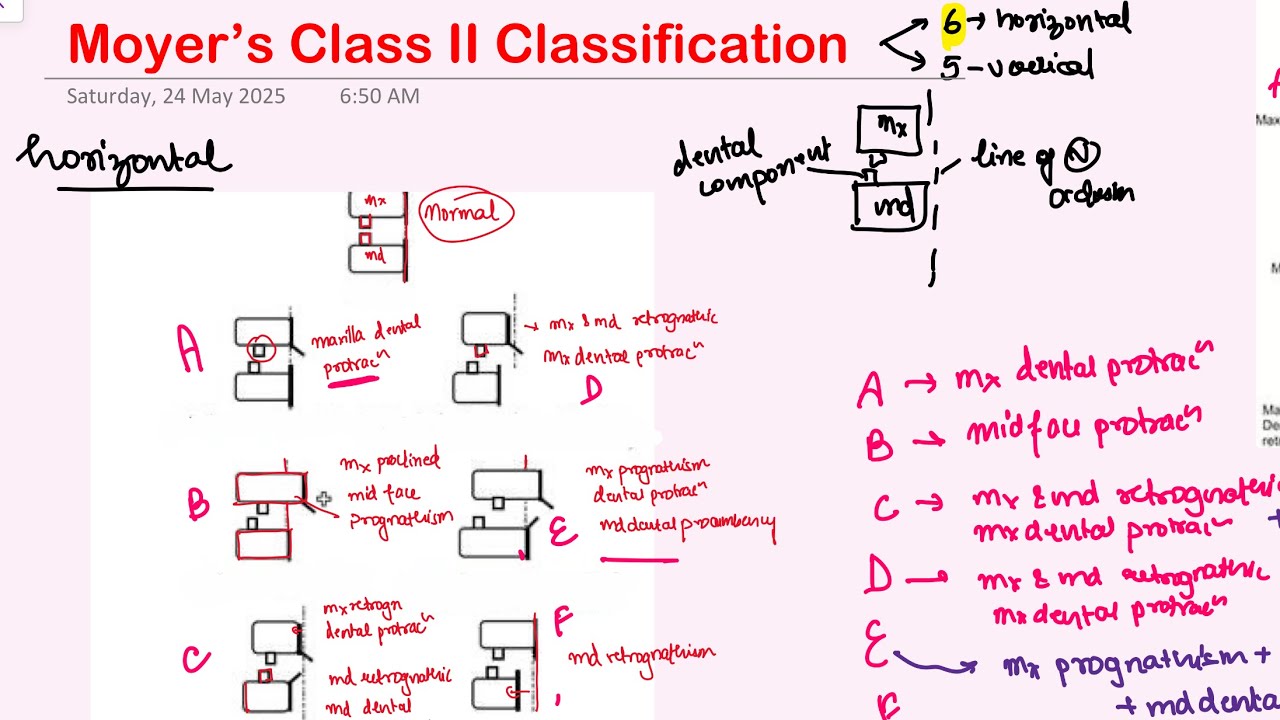 Moyer’s Class II Classification Orthodontics - YouTube
